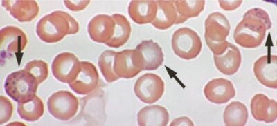 Anemia: Descripción General y Tipos | Concise Medical Knowledge