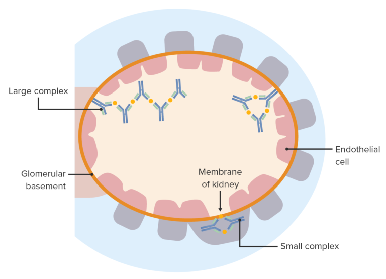 Type III Hypersensitivity Reaction | Concise Medical Knowledge