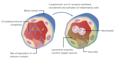 Type III Hypersensitivity Reaction | Concise Medical Knowledge