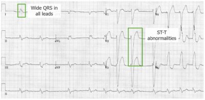 Bundle Branch and Fascicular Blocks | Concise Medical Knowledge