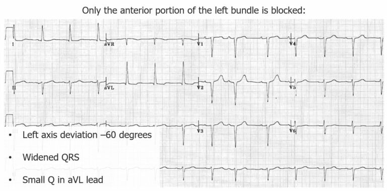 Bundle Branch and Fascicular Blocks | Concise Medical Knowledge