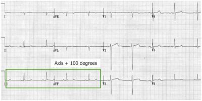 Bundle Branch and Fascicular Blocks | Concise Medical Knowledge