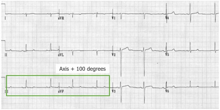 Bundle Branch and Fascicular Blocks | Concise Medical Knowledge