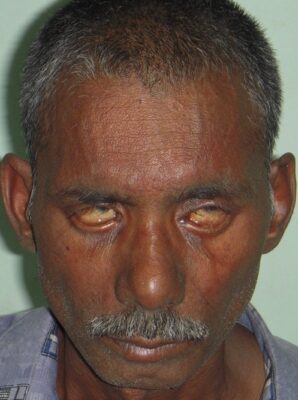 Lepra | Concise Medical Knowledge