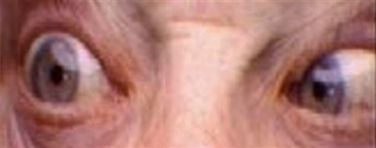 Cranial Nerve Palsies | Concise Medical Knowledge