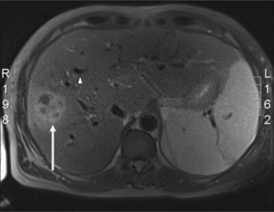 Absceso Hepático Piógeno | Concise Medical Knowledge