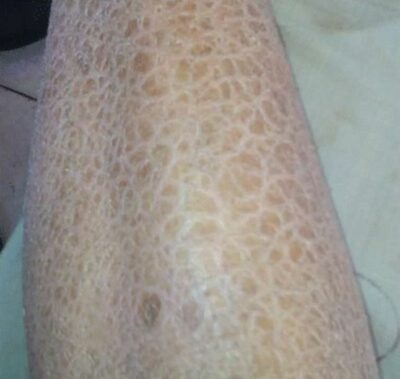 Lesiones Cutáneas Secundarias | Concise Medical Knowledge