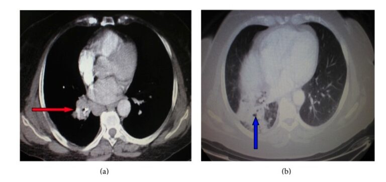 Atelectasis | Concise Medical Knowledge