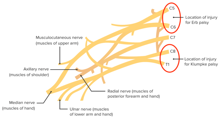 Brachial Plexus Injuries | Concise Medical Knowledge