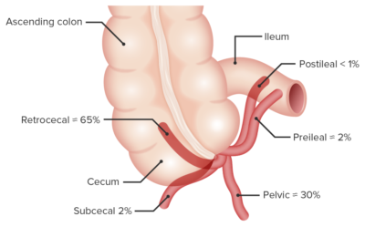 Appendectomy | Concise Medical Knowledge
