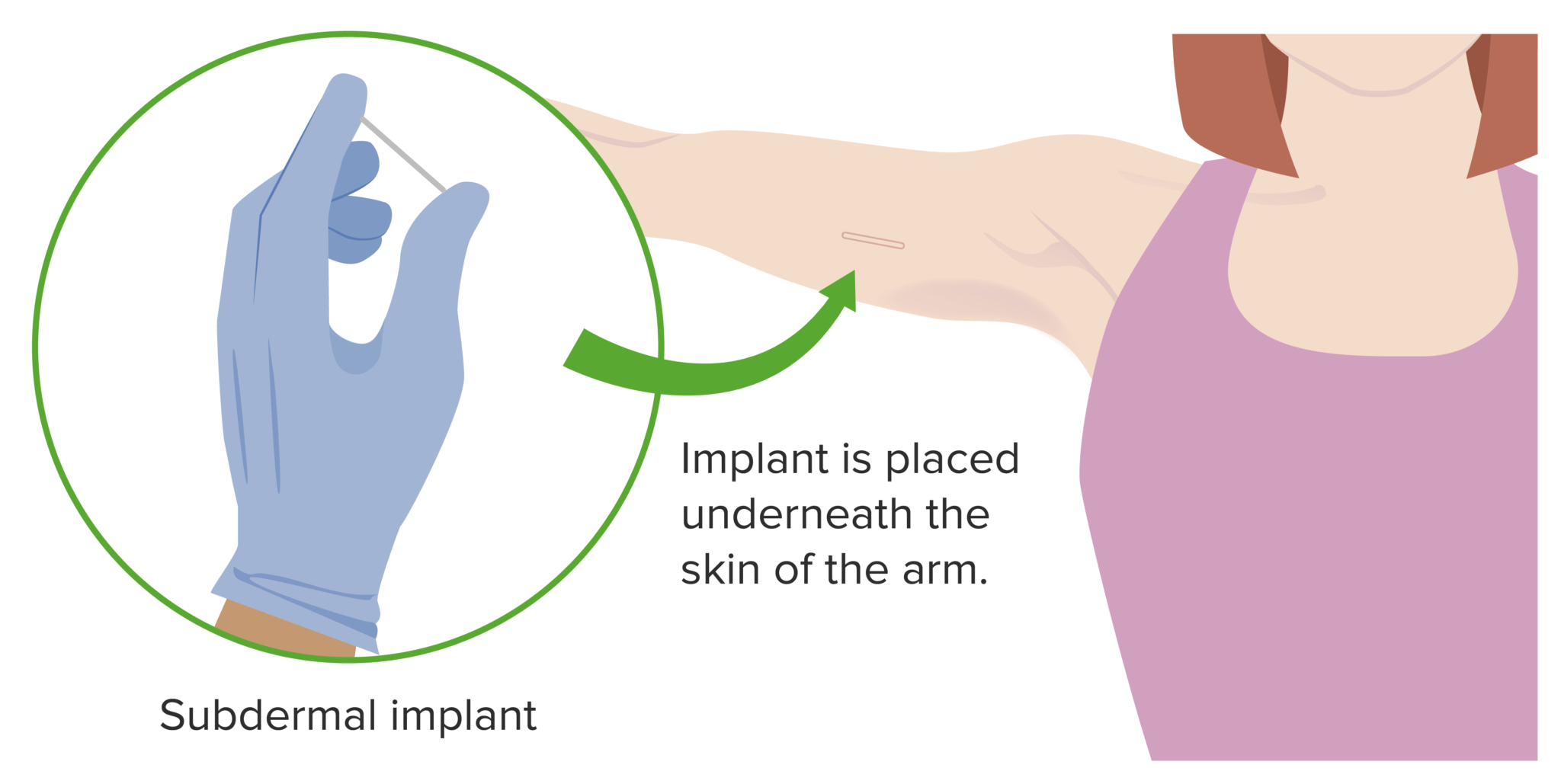 Hormonal Contraceptives | Concise Medical Knowledge