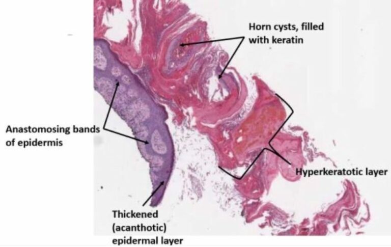 Seborrheic Keratosis Concise Medical Knowledge