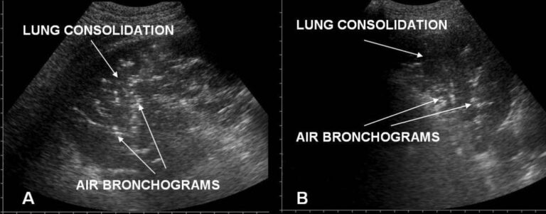 Síndrome de Dificultad Respiratoria Aguda (SDRA) | Concise Medical ...