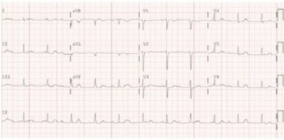 Lyme Disease | Concise Medical Knowledge