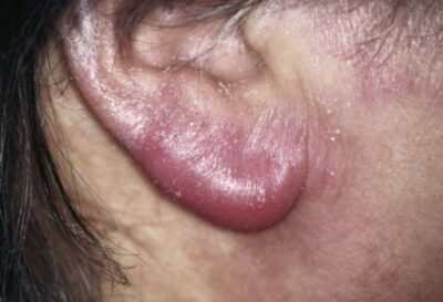 Lyme Disease | Concise Medical Knowledge