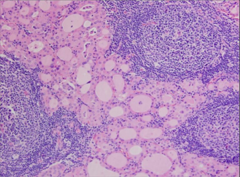 Tiroiditis de Hashimoto | Concise Medical Knowledge