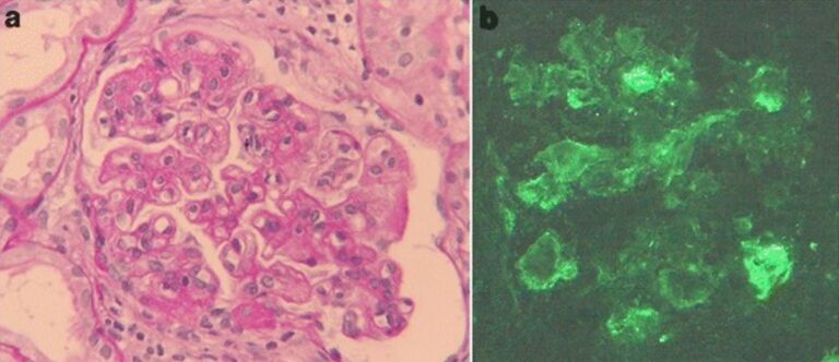 Membranoproliferative Glomerulonephritis Concise Medical Knowledge