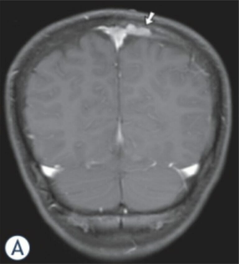 Langerhans Cell Histiocytosis | Concise Medical Knowledge