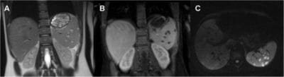 Imaging of the Spleen | Concise Medical Knowledge