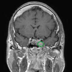 Acromegaly and Gigantism | Concise Medical Knowledge