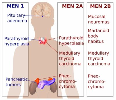Neoplasia Endocrina Múltiple Concise Medical Knowledge