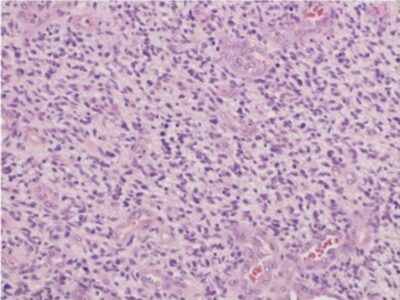 Astrocitoma | Concise Medical Knowledge