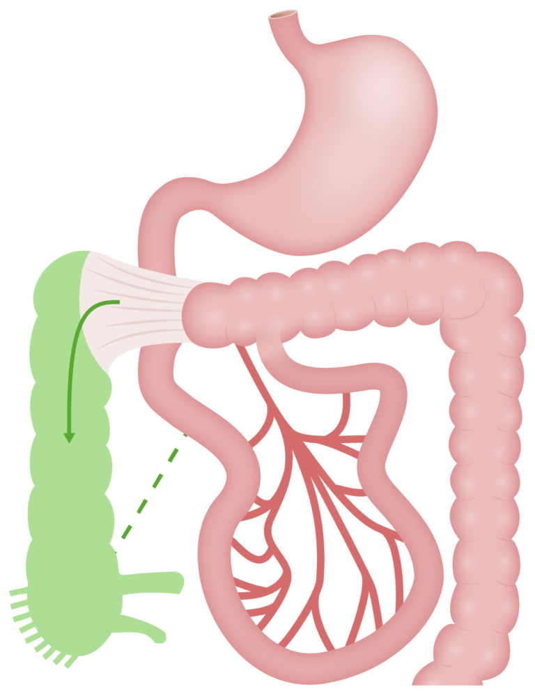 Intestinal Malrotation | Concise Medical Knowledge
