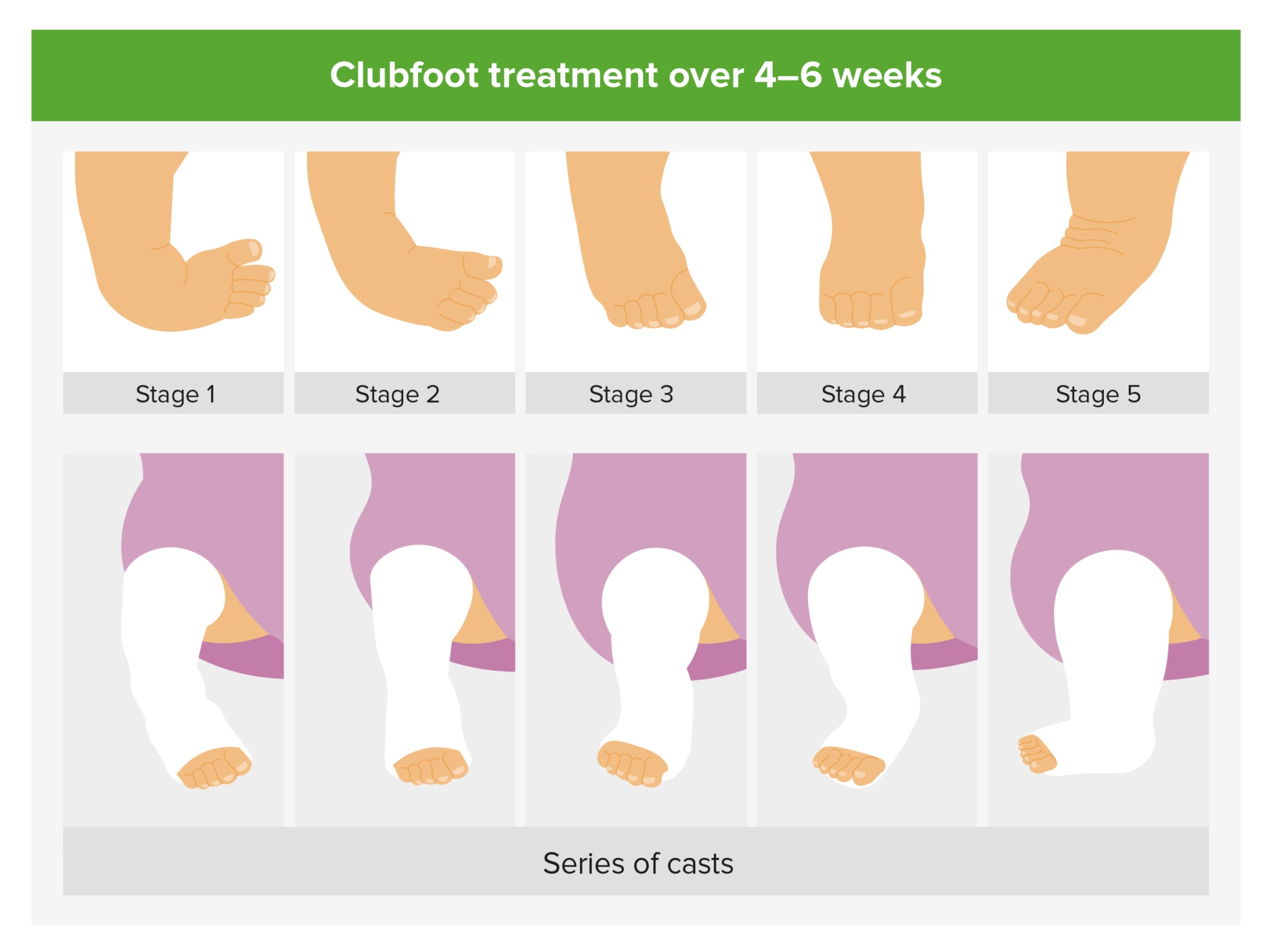 Foot Deformities | Concise Medical Knowledge