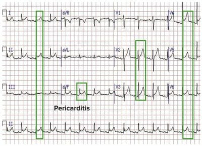 Pericarditis | Concise Medical Knowledge