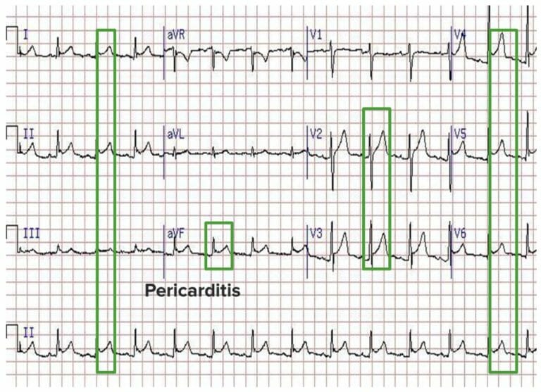 Pericarditis (Clinical) | Concise Medical Knowledge