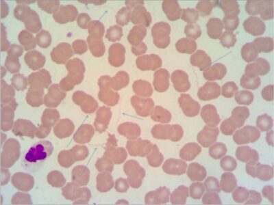 Febre Recorrente | Concise Medical Knowledge