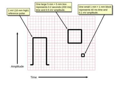 How to Read an ECG: Interpretation & Components | Lecturio Medical