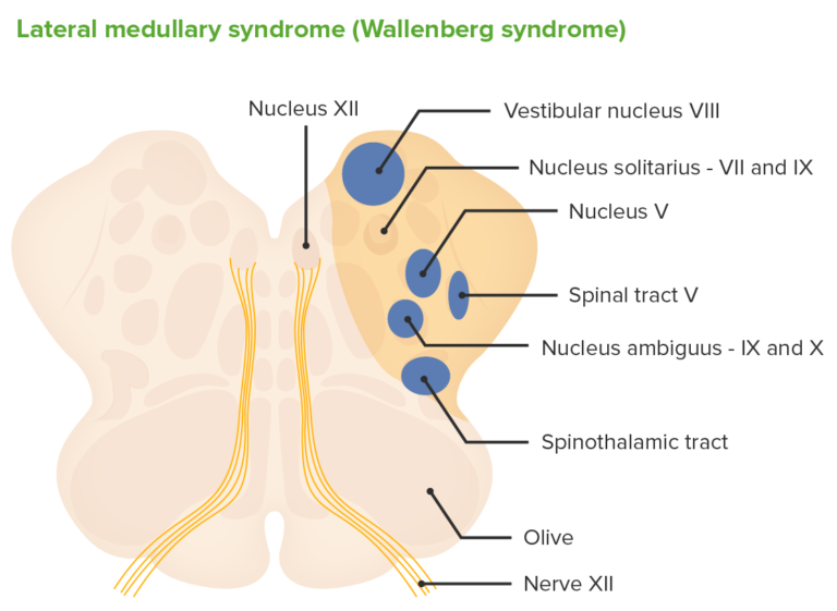 Lateral Medullary Syndrome (Wallenberg Syndrome) | Concise Medical ...