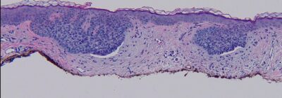 Carcinoma de Células Basais | Concise Medical Knowledge