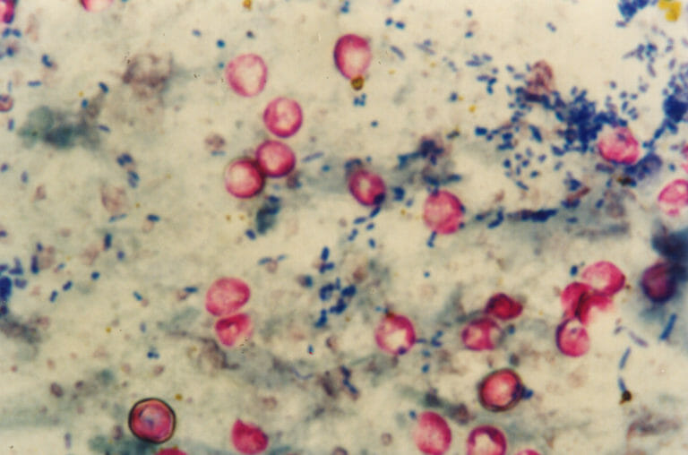 Cryptosporidium/Cryptosporidiosis | Concise Medical Knowledge