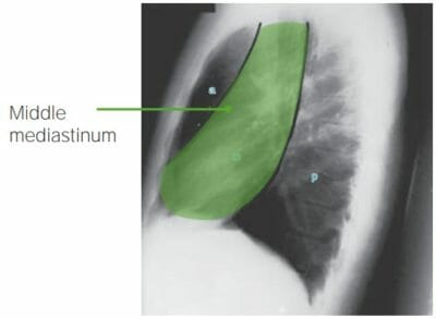 Imaging of the Mediastinum | Concise Medical Knowledge