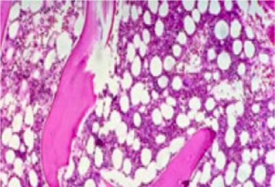 Aplastic Anemia | Concise Medical Knowledge