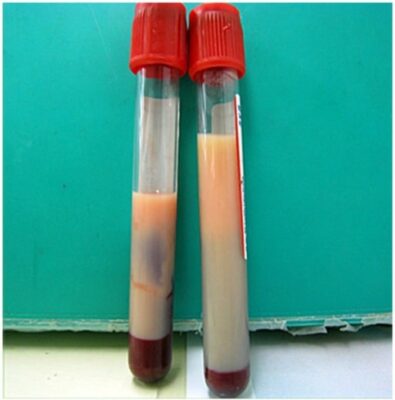 Pancreatitis aguda | Concise Medical Knowledge