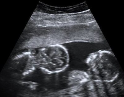 Multiple Pregnancy | Concise Medical Knowledge