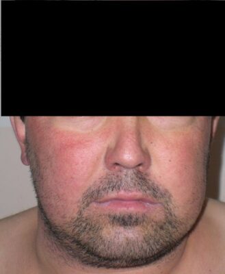 Paraneoplastic Syndromes | Concise Medical Knowledge