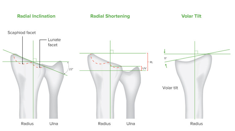 Distal Radius Fractures | Concise Medical Knowledge