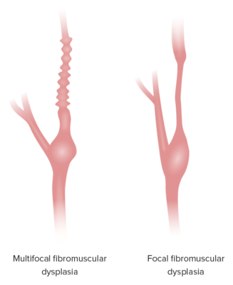 Fibromuscular Dysplasia | Concise Medical Knowledge