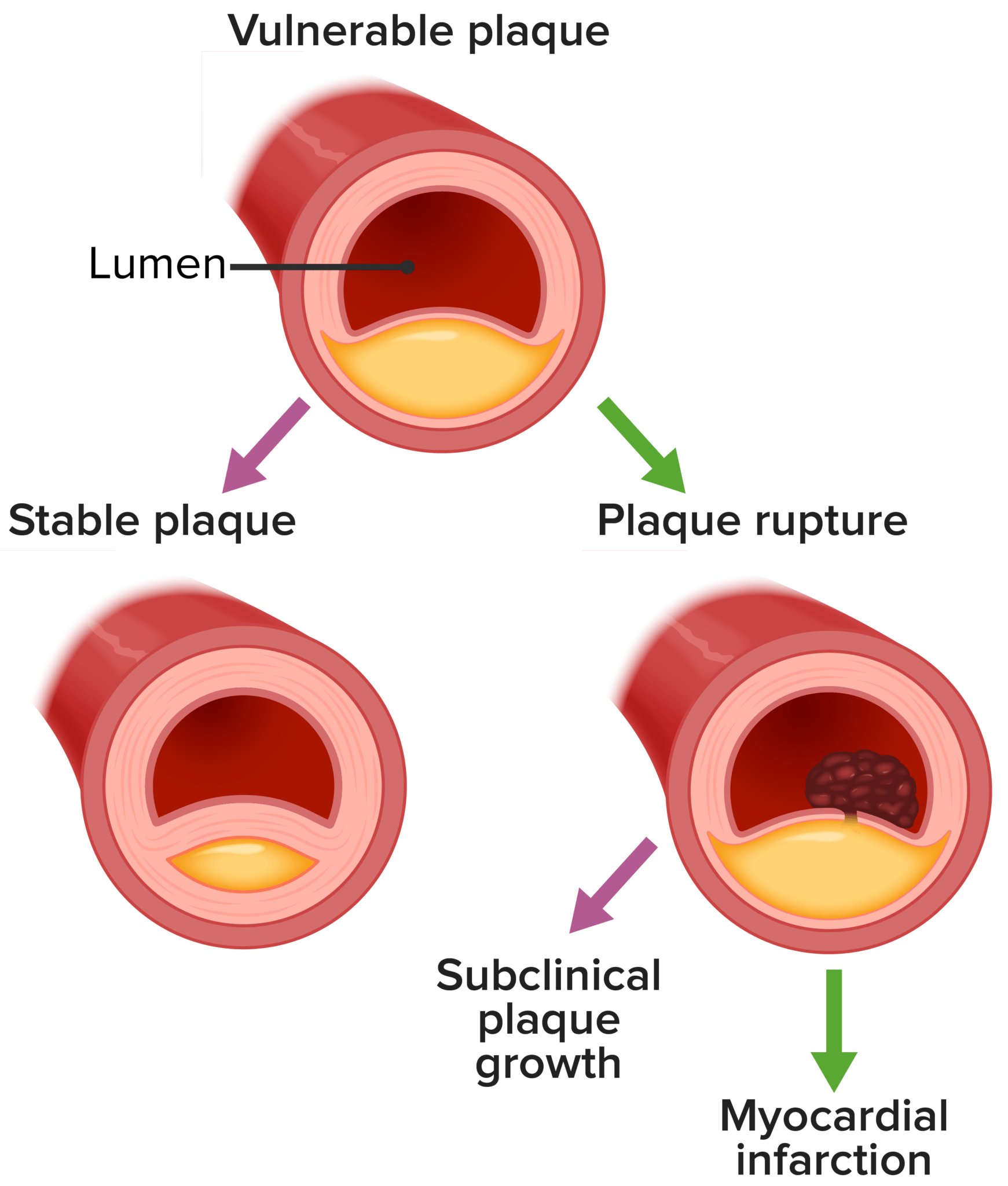 Acute Coronary Syndrome (Myocardial Infarction and Unstable Angina ...