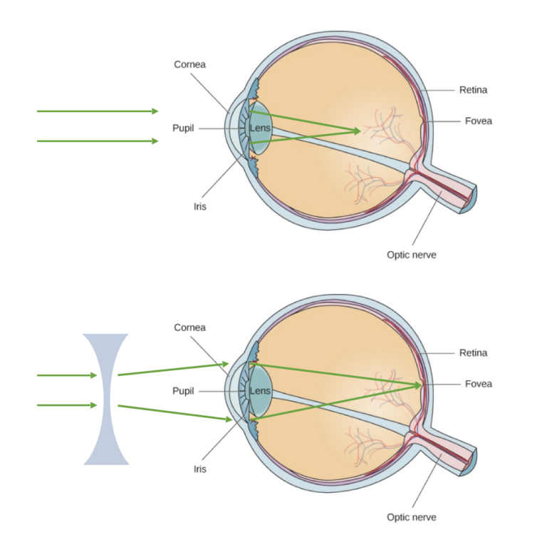 Errores de Refracción | Concise Medical Knowledge