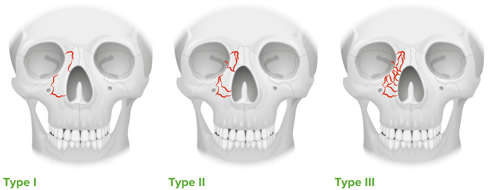 Orbital Fractures | Concise Medical Knowledge
