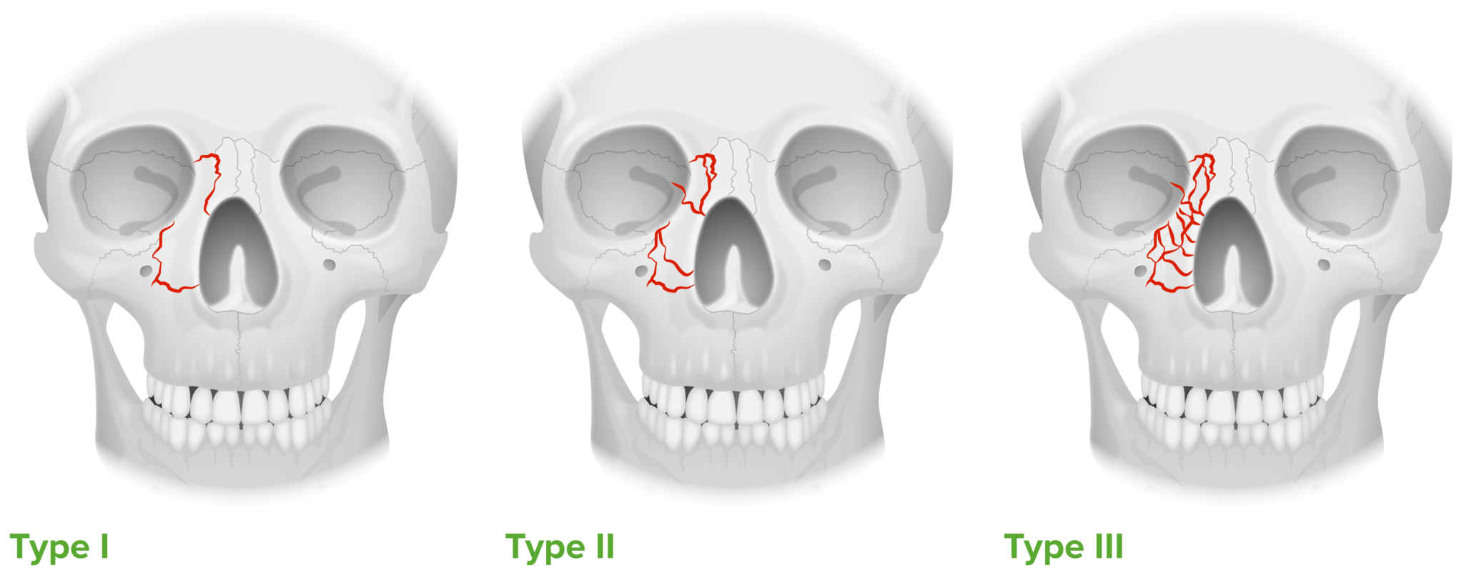 Orbital Fractures | Concise Medical Knowledge
