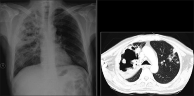 Pneumonia | Concise Medical Knowledge