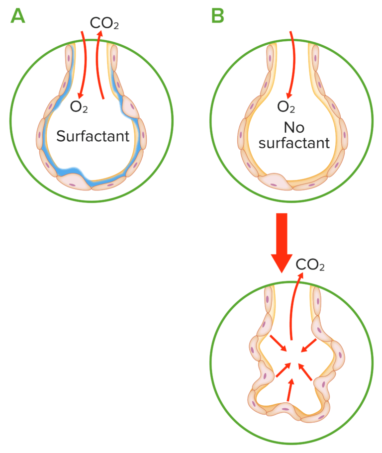 Neonatal Respiratory Distress Syndrome | Concise Medical Knowledge Neonatal Respiratory Distress Syndrome | Concise Medical Knowledge