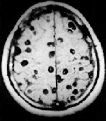 Taenia/Teniasis | Concise Medical Knowledge