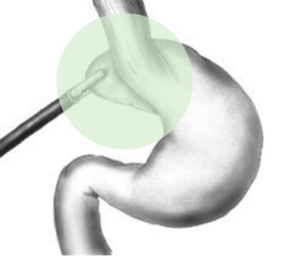 Gastroesophageal Reflux Disease (GERD) | Concise Medical Knowledge